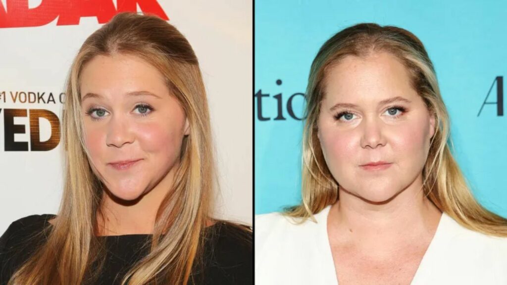 Amy Schumer’s 10-Pound Weight Gain Battle With Endometriosis